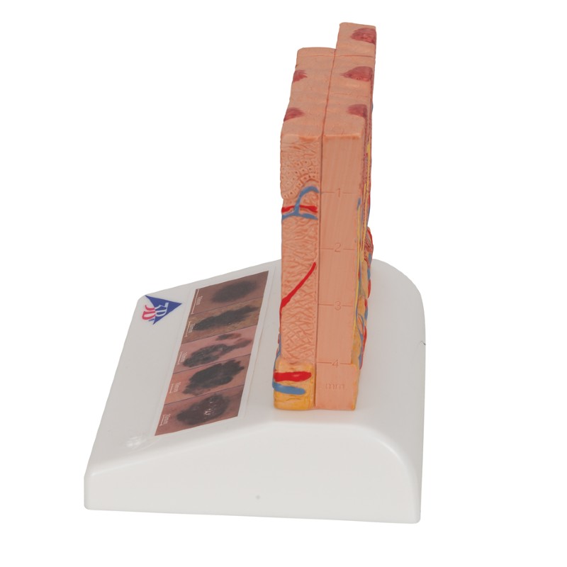 3B Scientific Magnified Skin Cancer Model | Health and Care